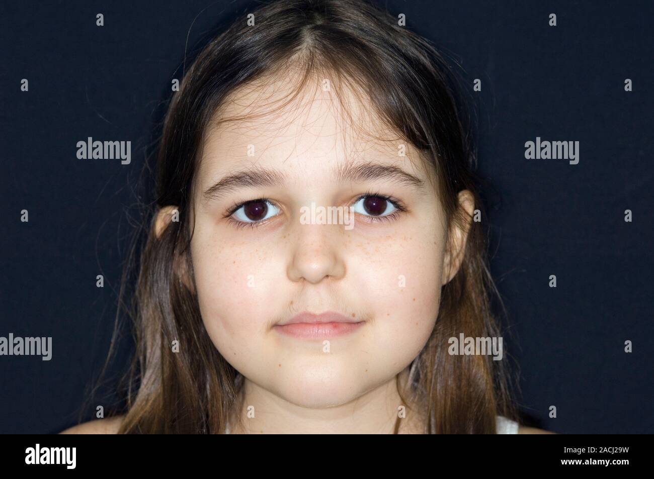 Blasse Haut (Blässe) wegen Anämie (Hämoglobin 66) in einer 9-jährigen ...