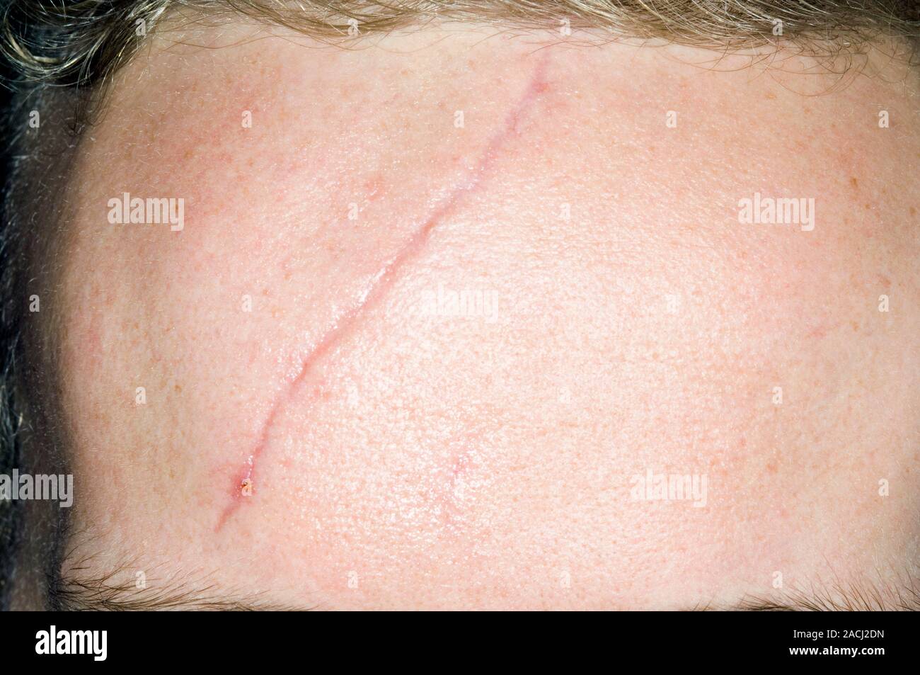 Narbe auf der Stirn, ein 26 Jahre alter männlicher Patient sechs Wochen ...