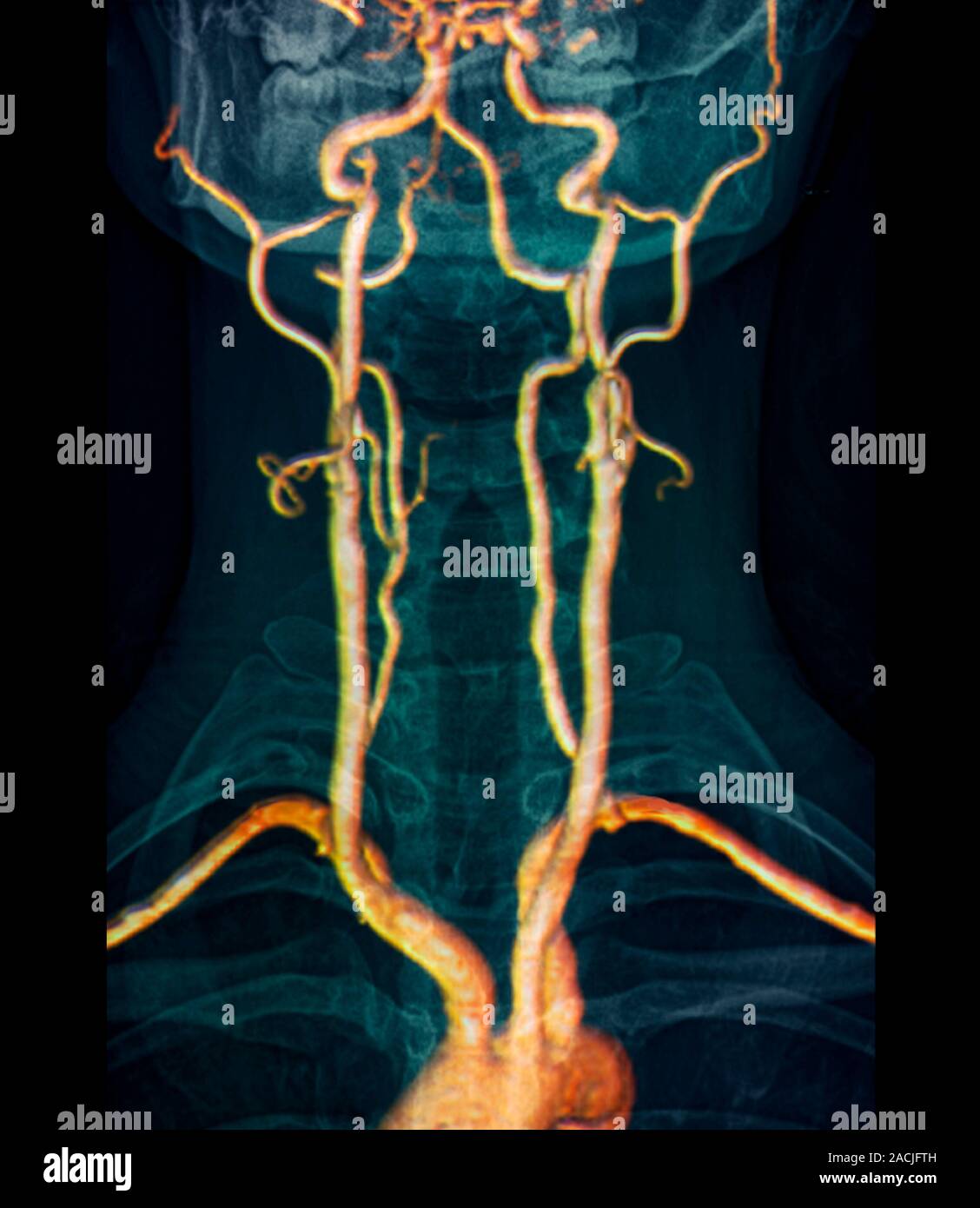 Farbige dreidimensionale (3D) Magnetresonanztomographie (MRT) der Hals ...