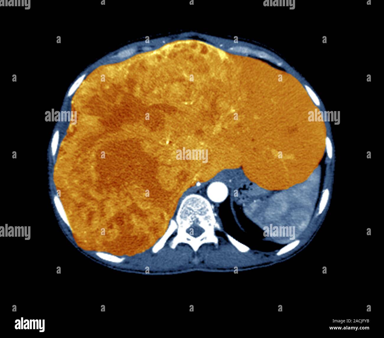 Farbige Computertomographie (CT) in den axialen Abschnitt des Abdomens ...