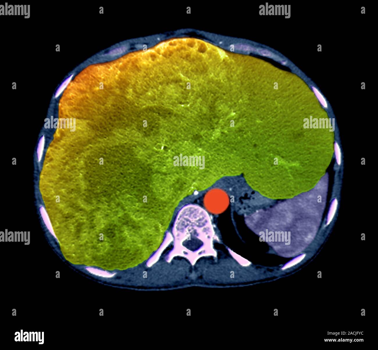 Farbige Computertomographie (CT) in den axialen Abschnitt des Abdomens ...