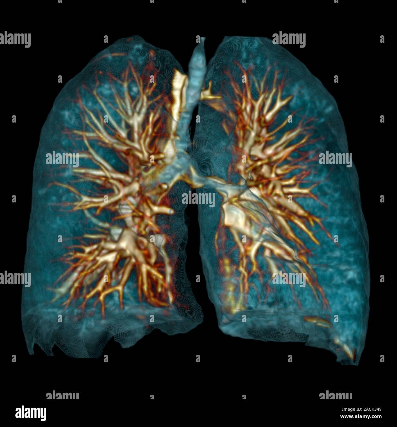 Emphysem. 3D-Computertomographie (CT) der Lunge eines 75 Jahre alten ...
