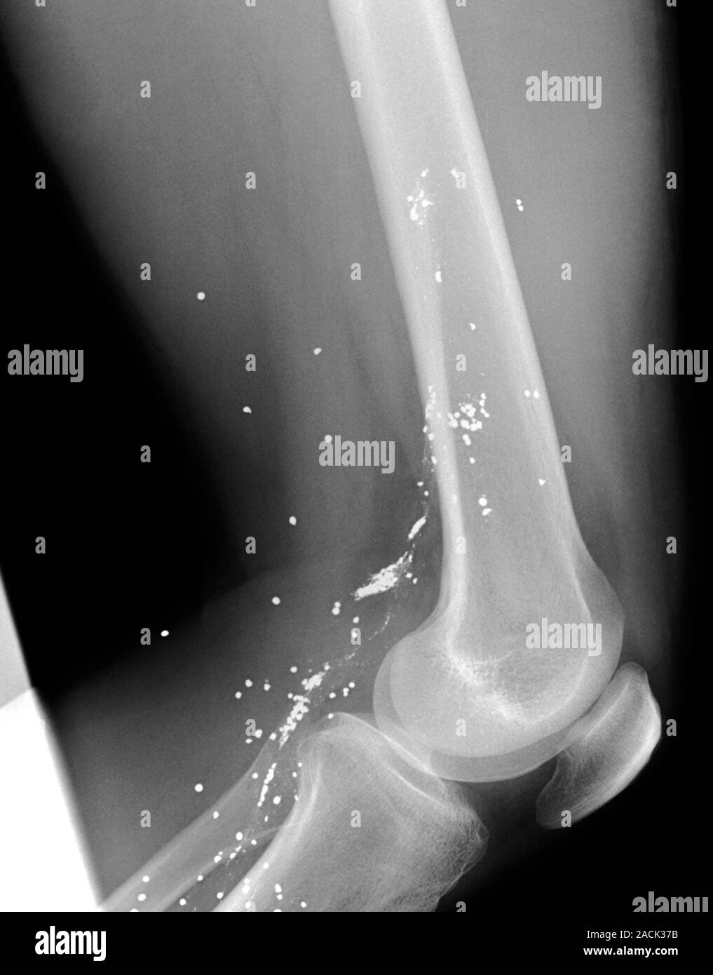 Schrapnell Verletzung. X-ray der Knie eines 42 Jahre alten männlichen ...
