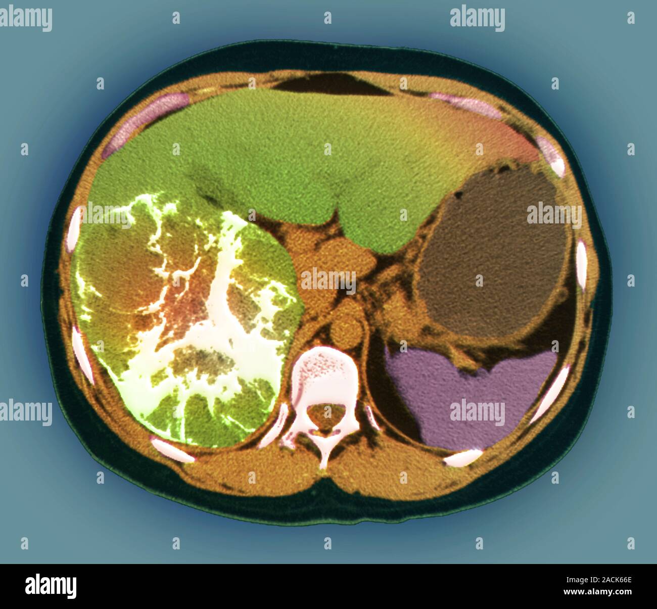 Leberkrebs. Farbige Computertomographie (CT) in den axialen Abschnitt ...