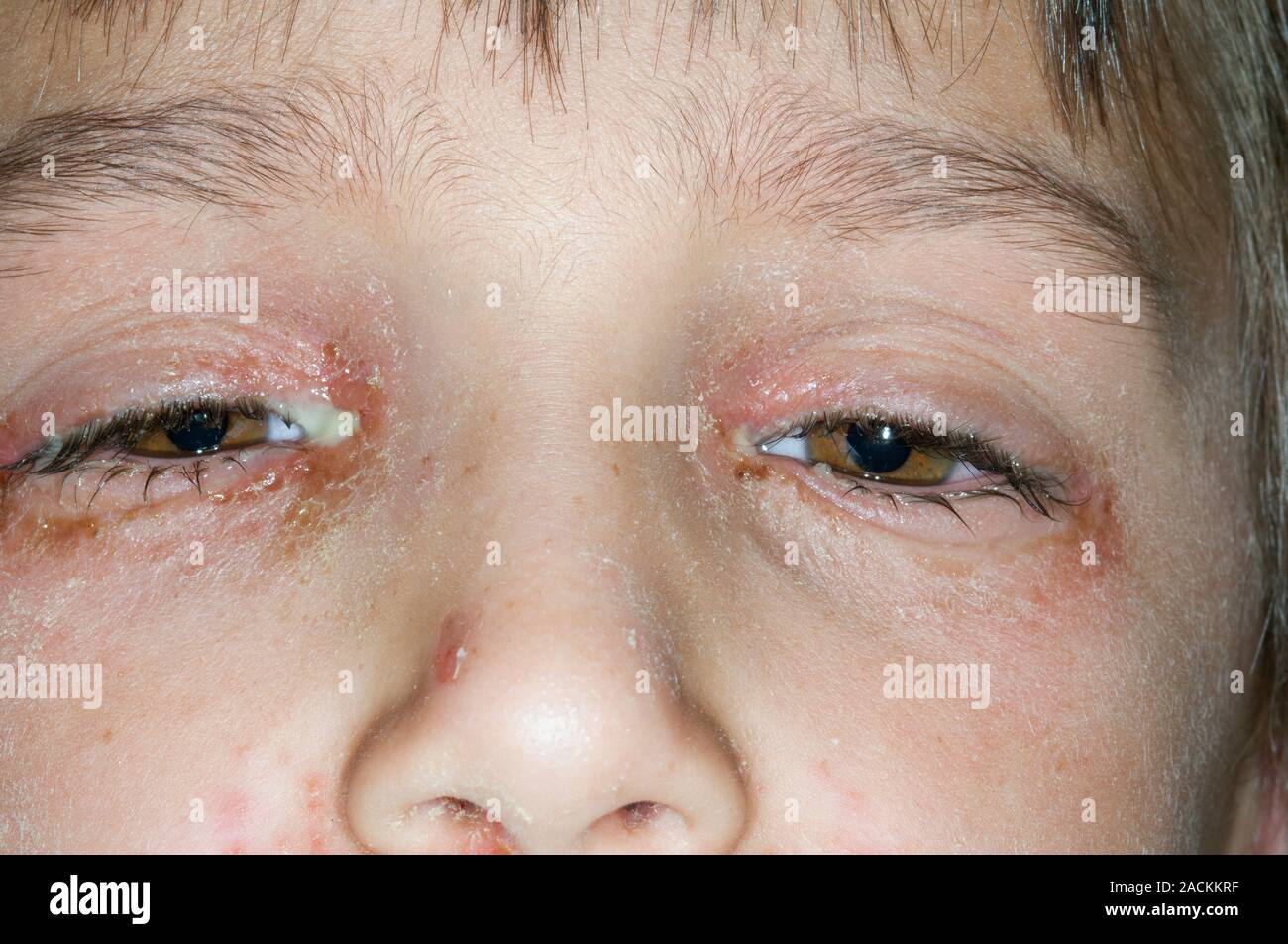 Nahaufnahme der entzündeten Augen in ein 10 Jahre alter männlicher ...