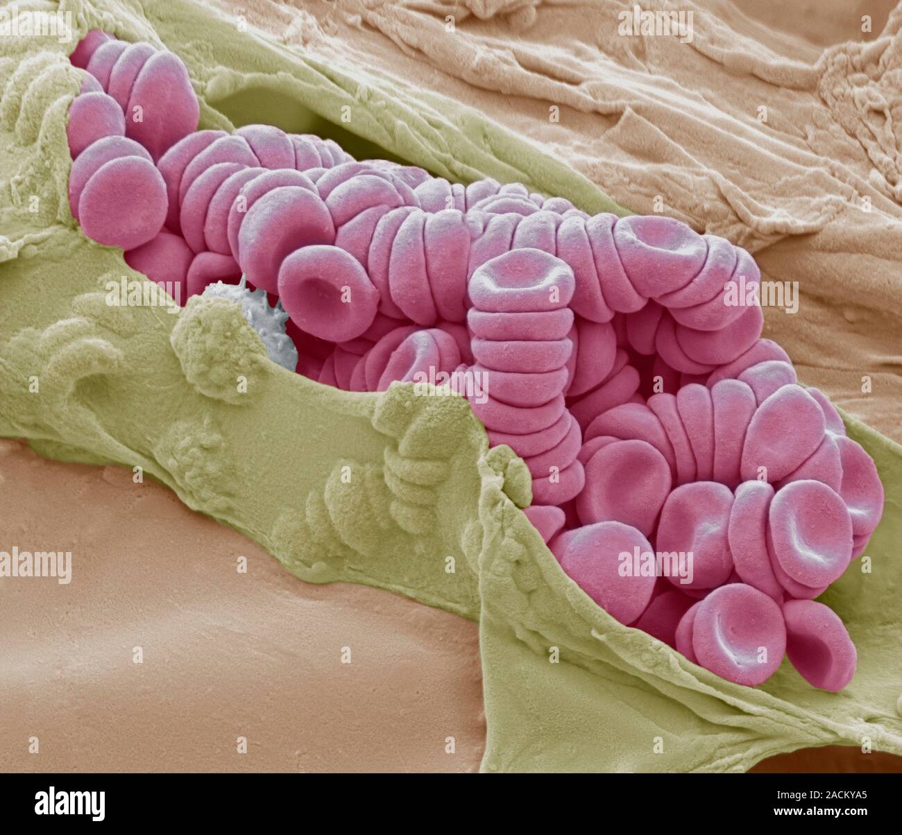 Die Geborstenen venule. Farbige Scanning Electron Micrograph (SEM ...