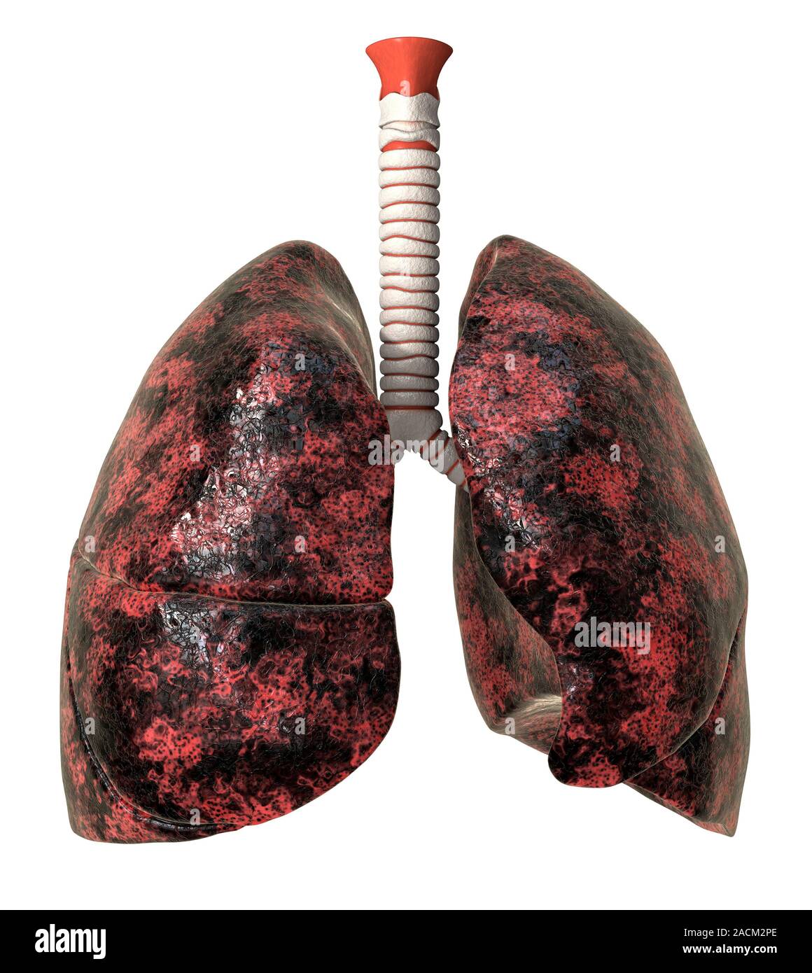 Smoker's Lungen. Computer Artwork der Lungen durch Rauchen beschädigt ...