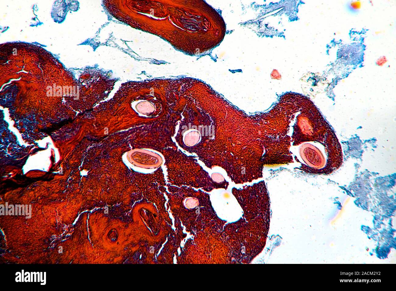 Scabies - betroffene Haut. Licht Schliffbild einer Sektion durch die ...