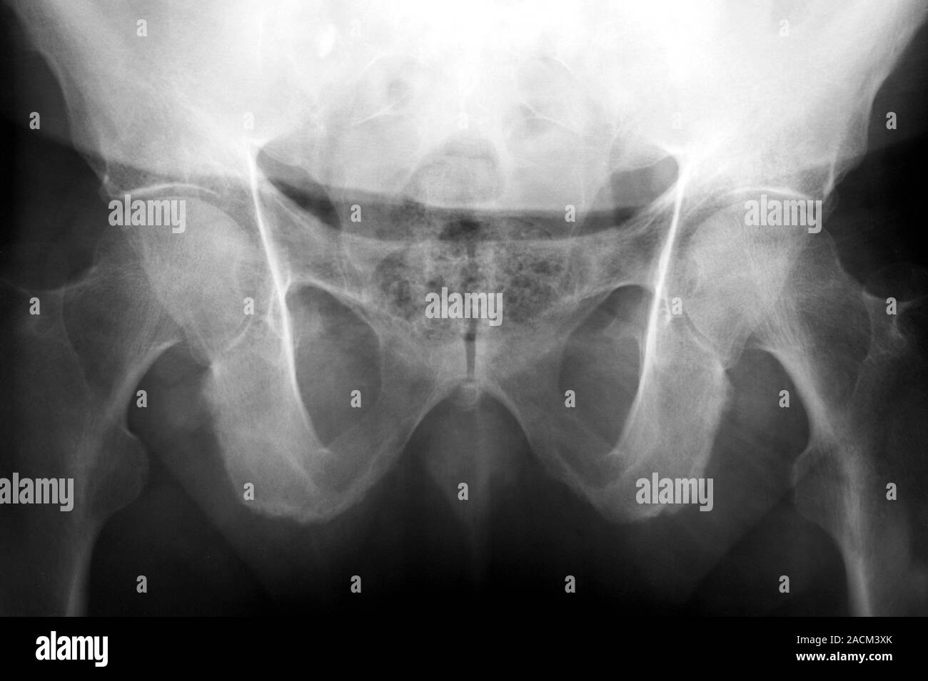 Sacroilitis. X-ray des Beckens eines 67 Jahre alten Mannes mit ...
