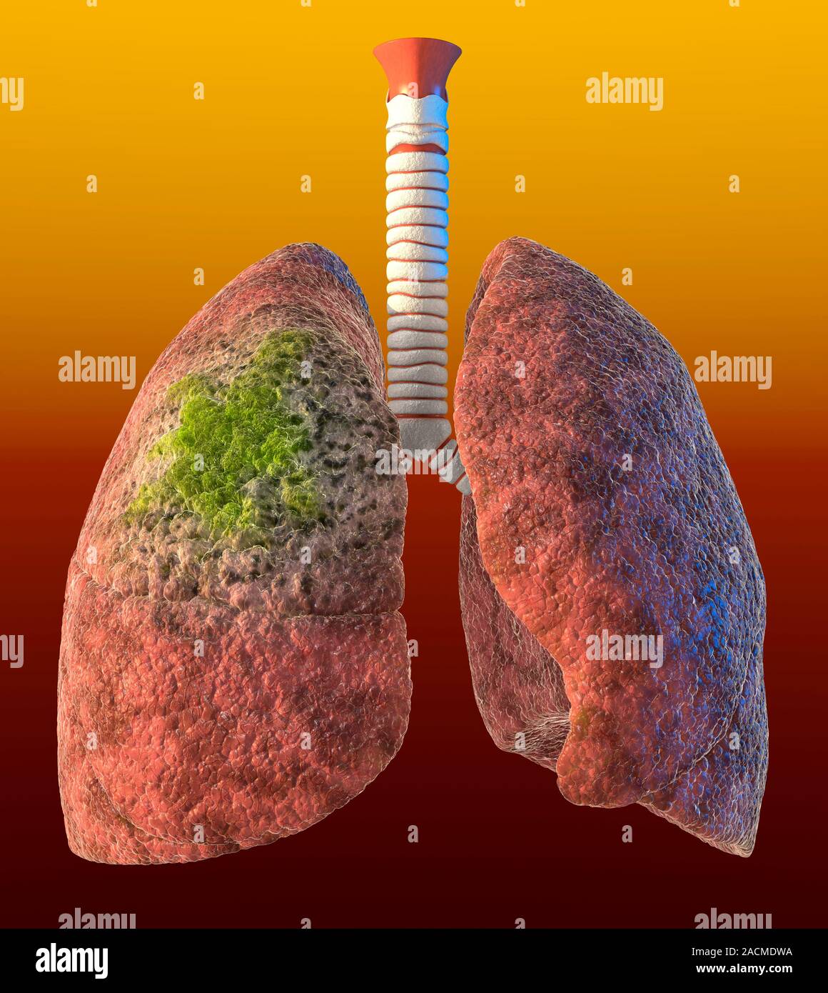 Lungenkrebs. Computer Kunstwerk eines malignen (bösartigen) Tumor (grün ...