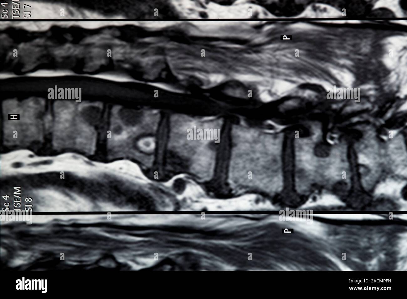 Die Magnetresonanztomographie (MRT) in sagittalschnitt Übersicht Krebs ...