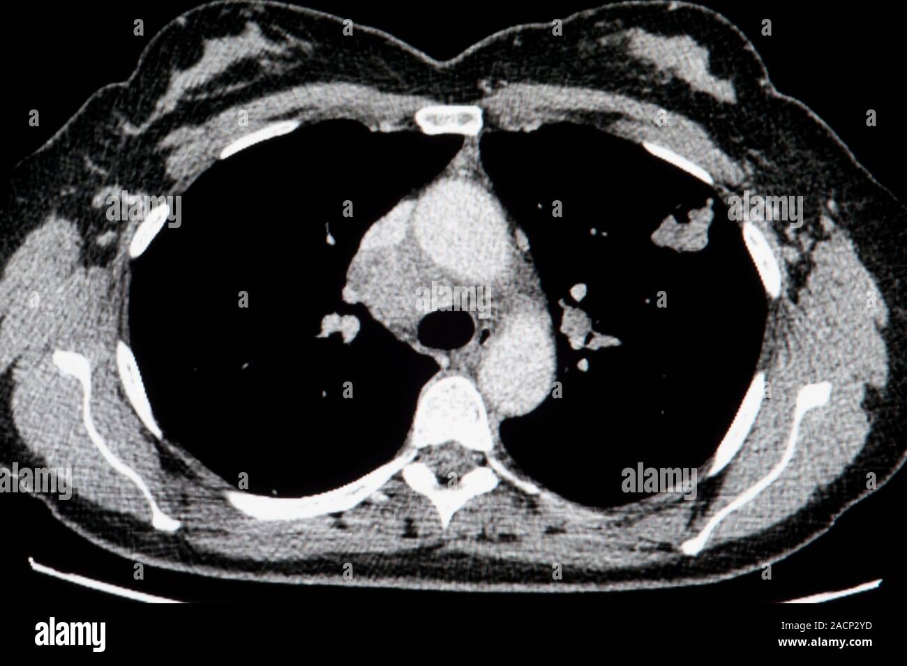 Computertomographie (CT) in den axialen Abschnitt Scan durch die Brust ...