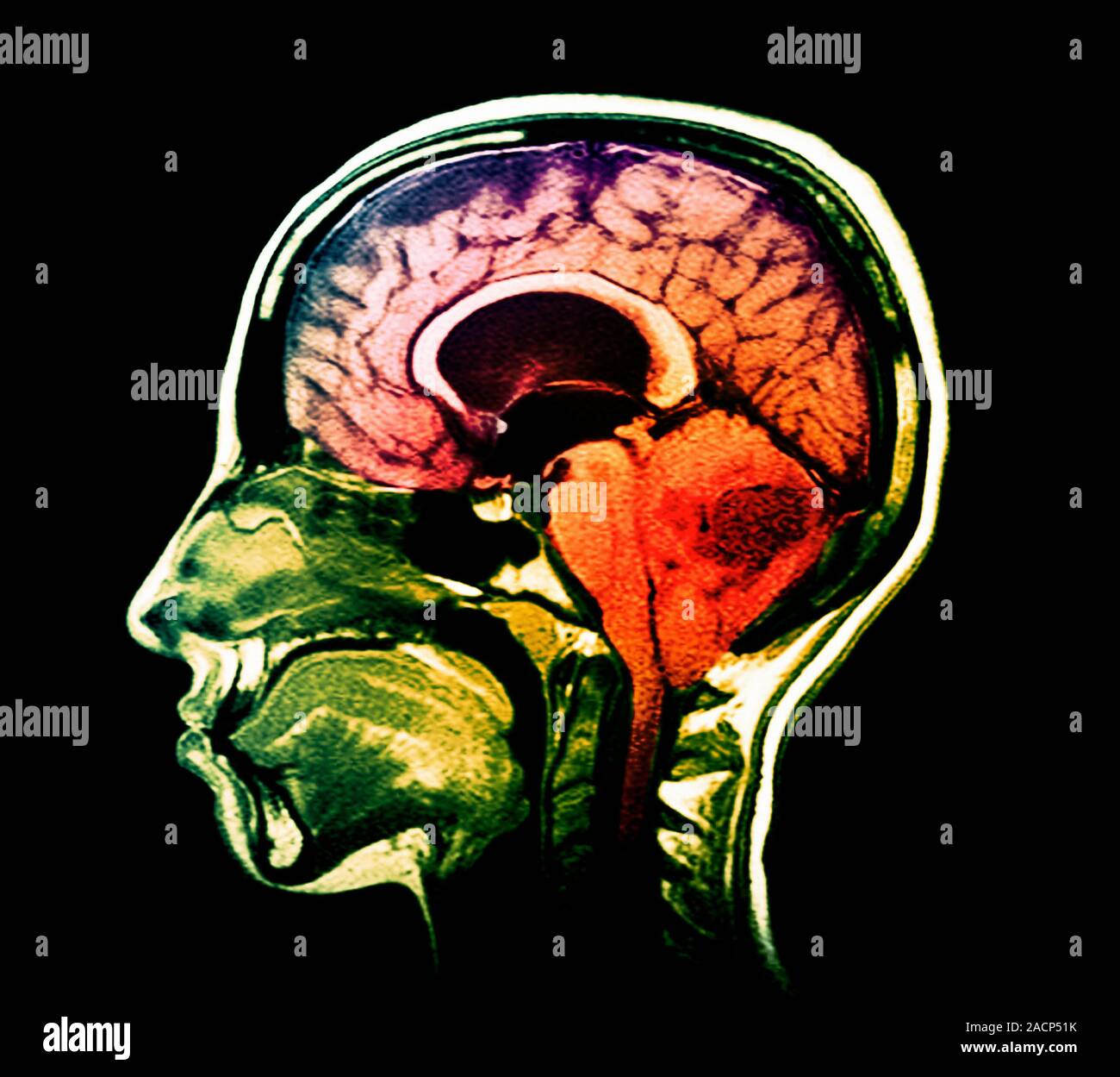 Hirntumor. Farbige Magnetresonanztomographie (MRT) Scan eines Sagittalschnitt durch den Kopf ...