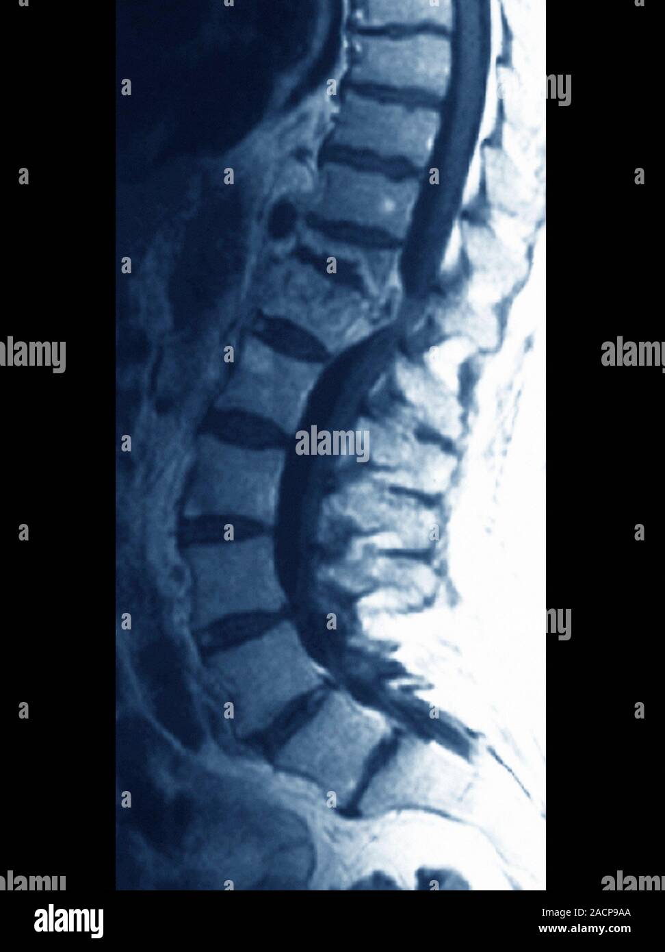 Tuberkulose der Wirbelsäule. Farbige Magnetresonanztomographie (MRT) Scan eines Sagittalschnitt ...