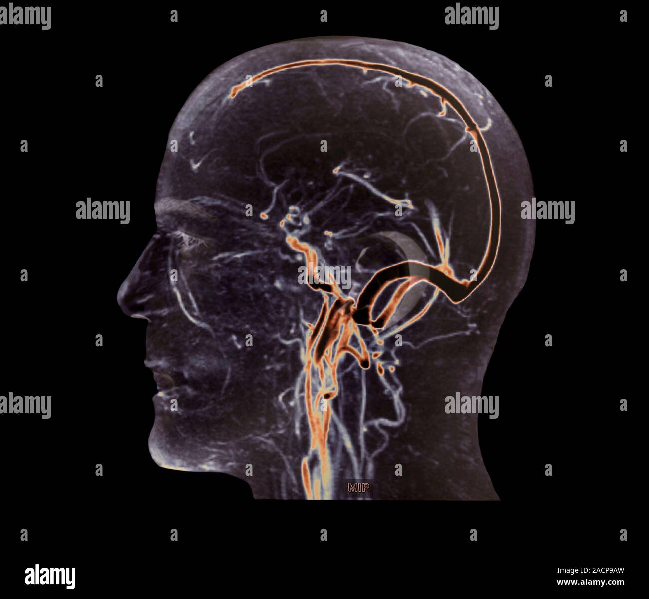 Gefäßsystem der Kopf. Farbige Magnetresonanztomographie (MRT) Angiographie eines Sagittalschnitt ...