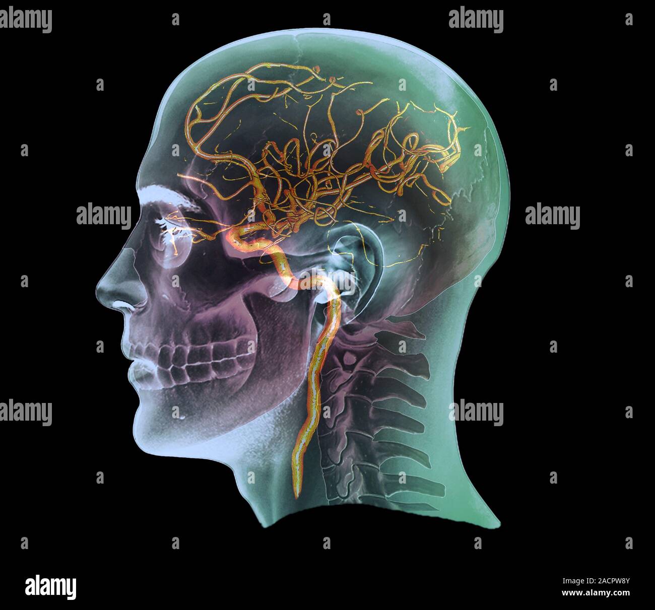 Arteria carotis interna. 3D-Computertomographie (CT) angiogram ...