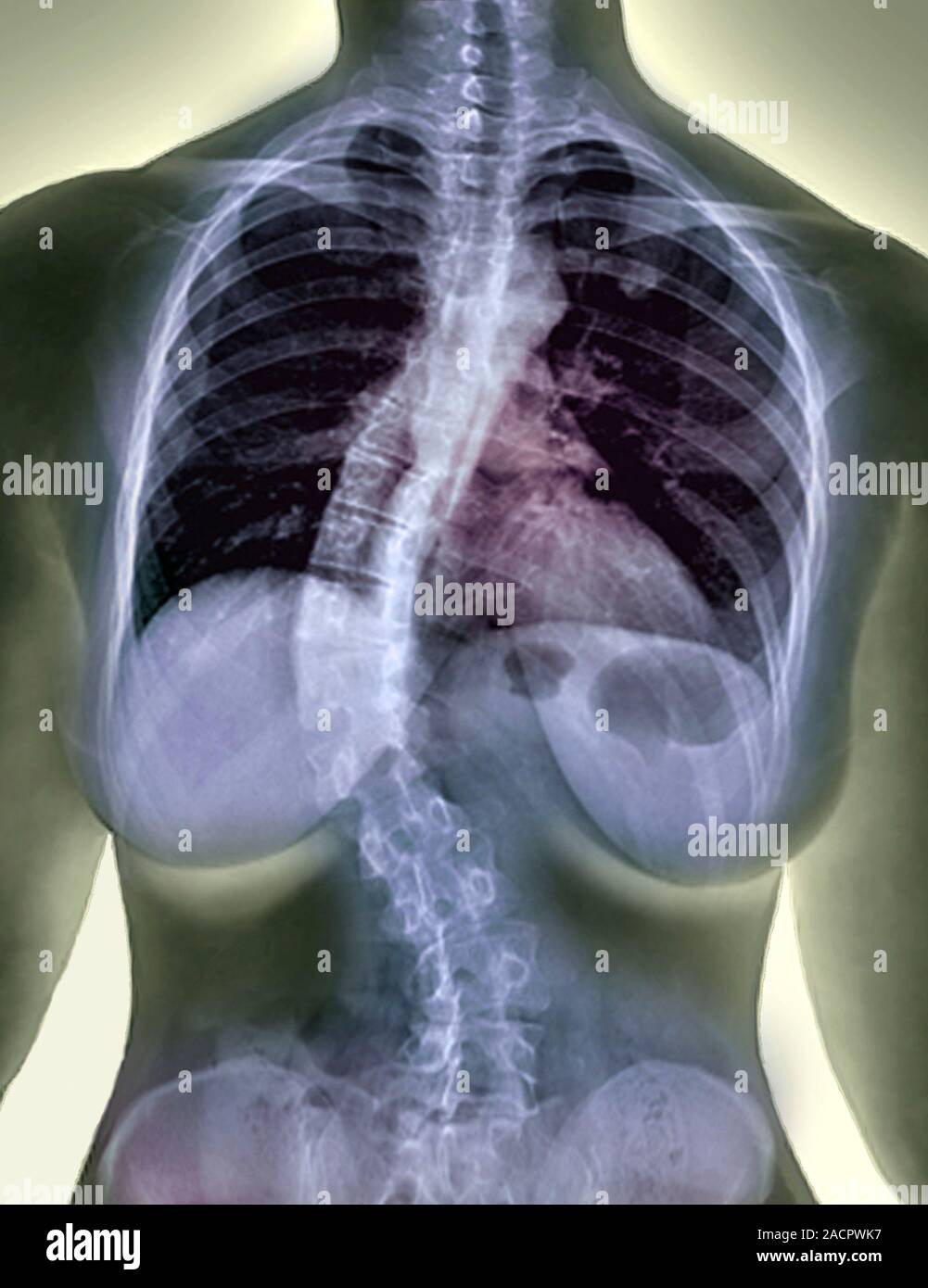 Skoliose der Wirbelsäule. Farbige X-ray von der Brust einer 34 Jahre ... Skoliose der Wirbelsäule. Farbige X-ray von der Brust einer 34 Jahre ...