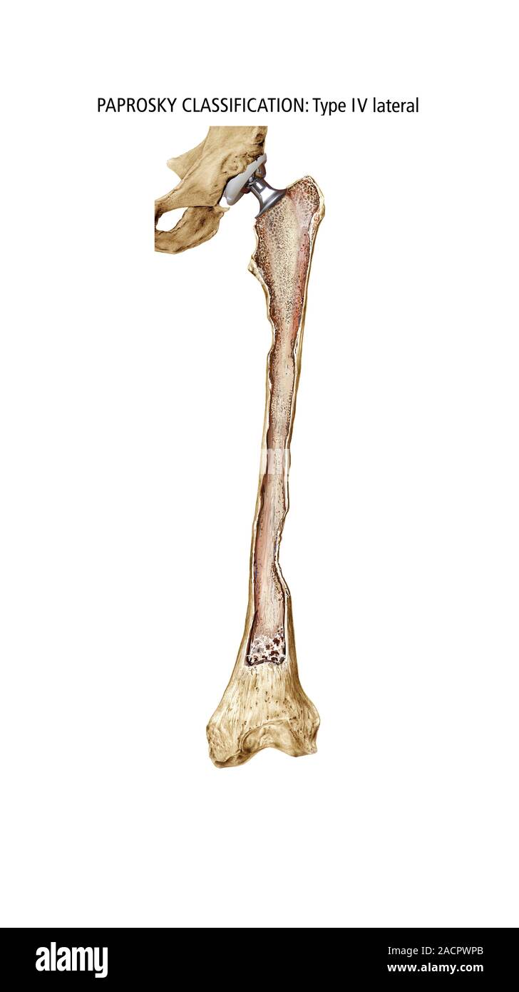 Paprosky Femur defekt. Cutaway Artwork von Knochen Abbau in einer Typ ...