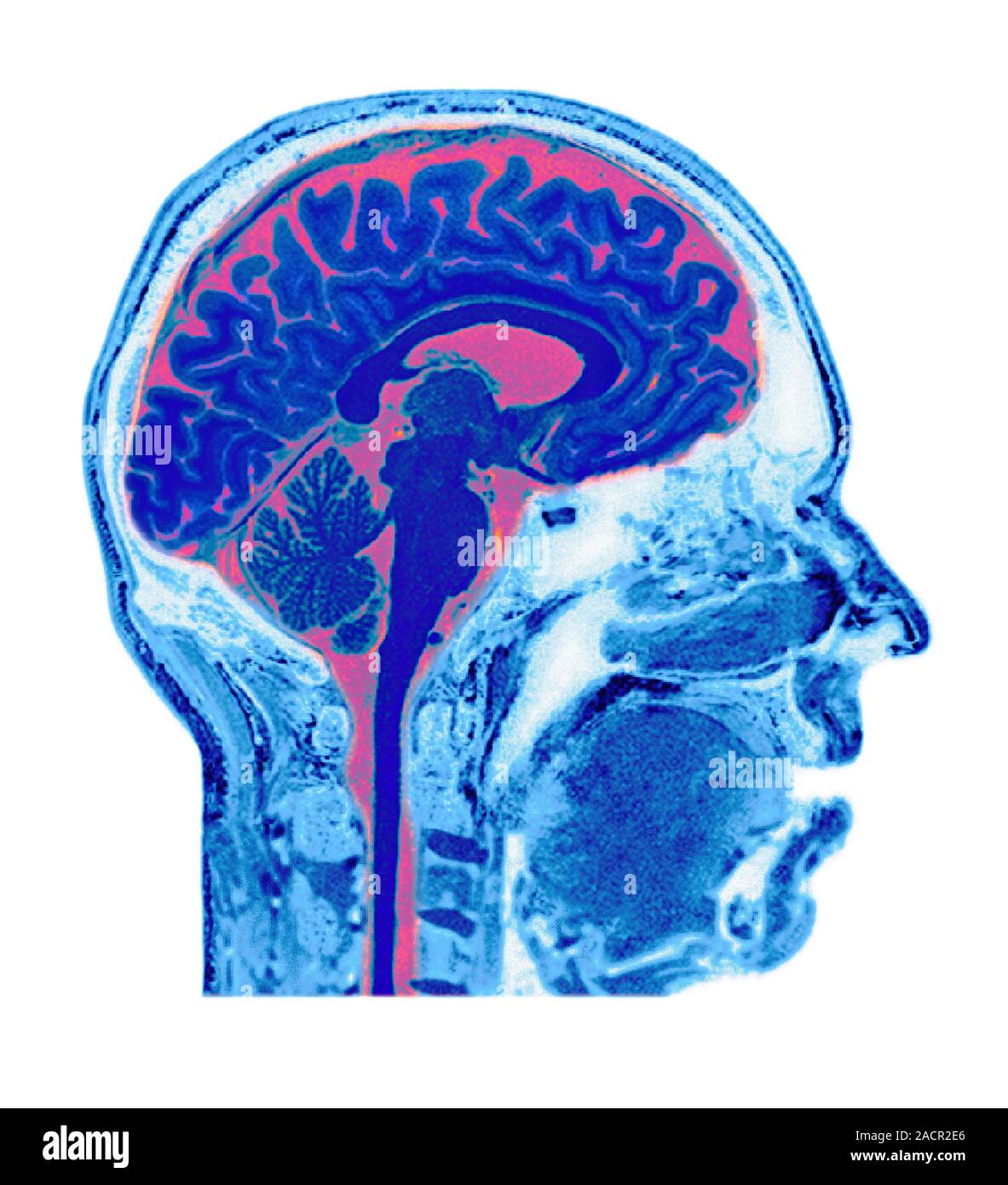 Gehirn. Farbige Magnetresonanztomographie (MRT) Scan eines Sagittalschnitt durch eines Patienten ...