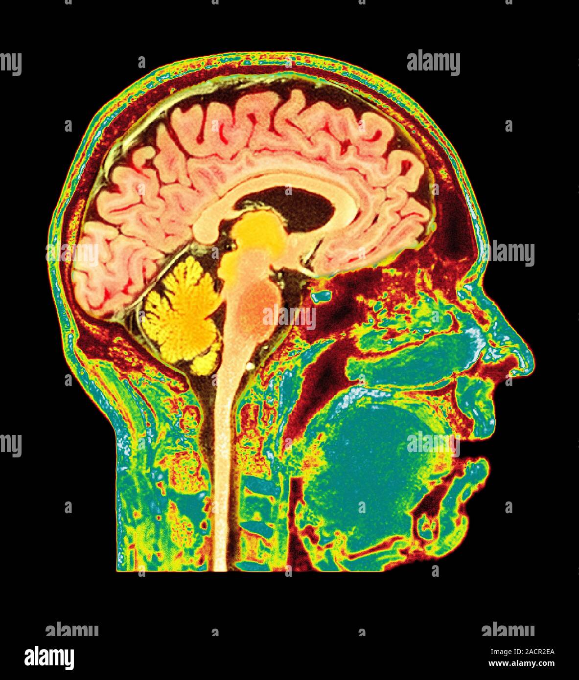 Gehirn. Farbige Magnetresonanztomographie (MRT) Scan eines Sagittalschnitt durch eines Patienten ...