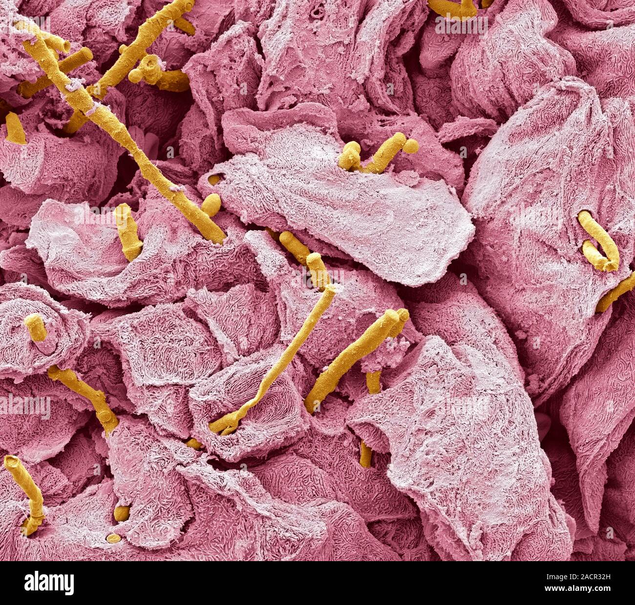 Soor Infektion der Zunge. Farbige Scanning Electron Micrograph (SEM ...
