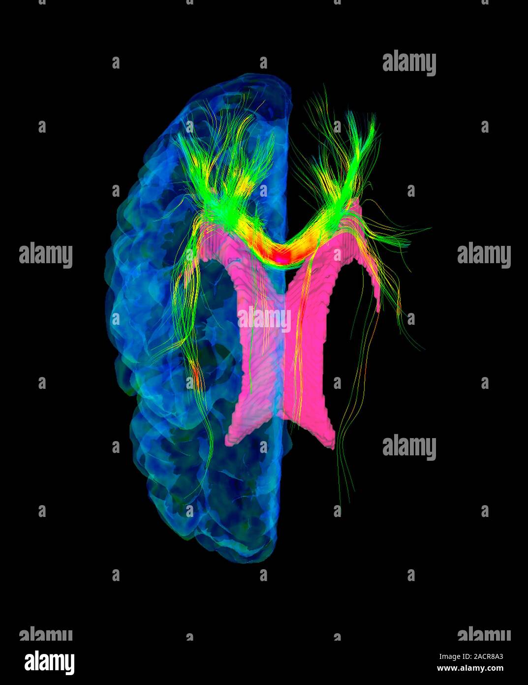 Gehirn Fasern. 3D-Diffusion Tensor Imaging (DTI ...