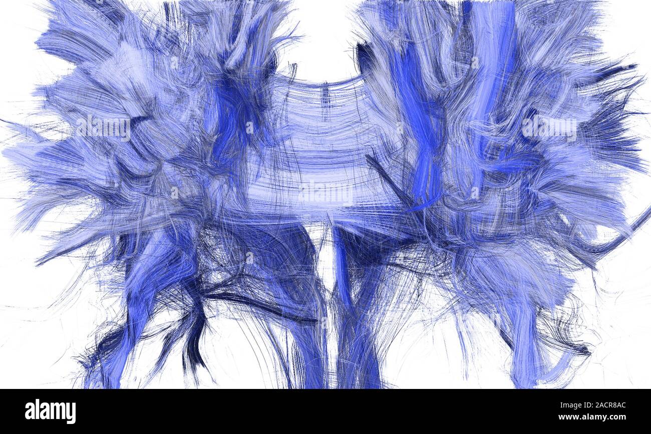 Corpus callosum. Koronale 3D-Diffusion Tensor Imaging (DTI ...