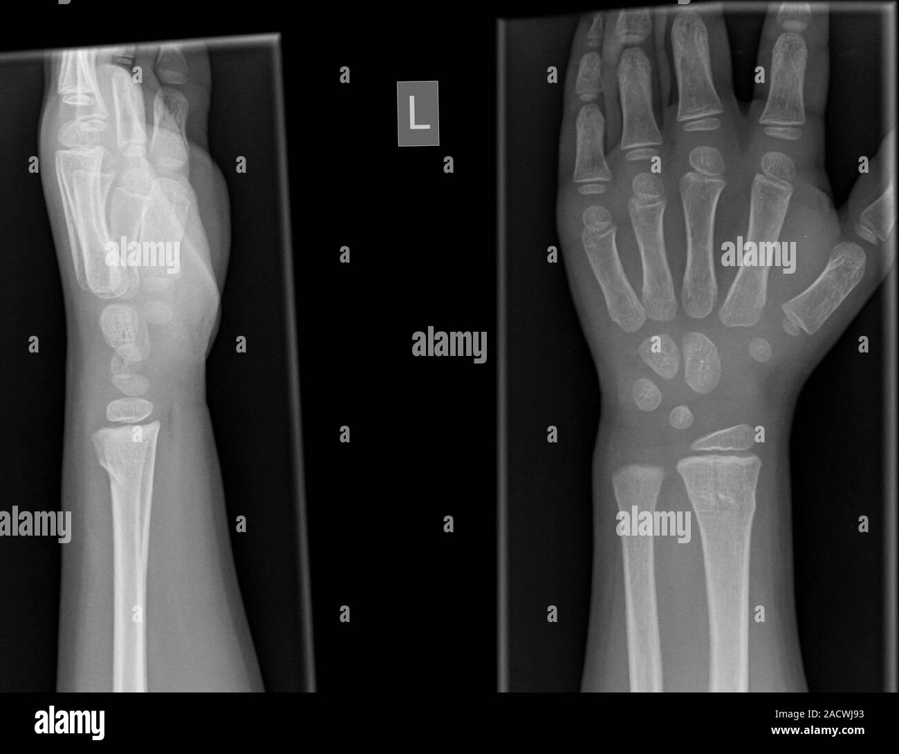 Handgelenk und Hand Röntgen eines 4 Jahre alten Kind männlichen mit ...