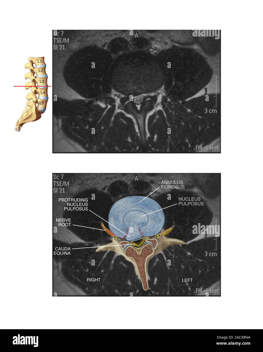 Bandscheibenvorfall in der Lendenwirbelsäule. Artwork und axiale MRI ...
