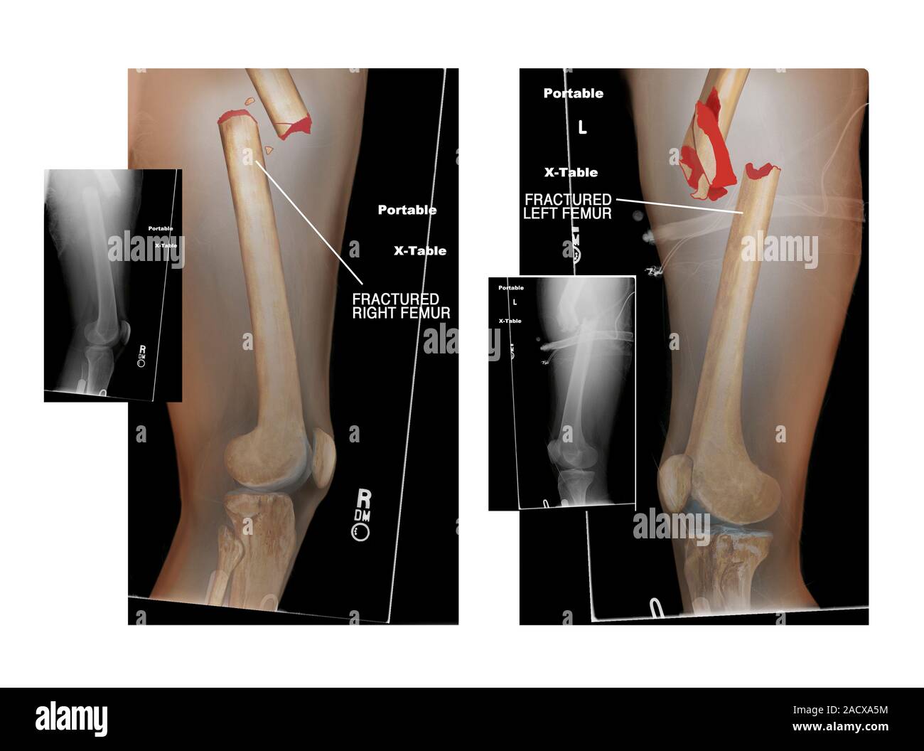 Frakturen des rechten und linken Oberschenkelknochen. Mit der Bezeichnung Kunstwerke kombiniert ...