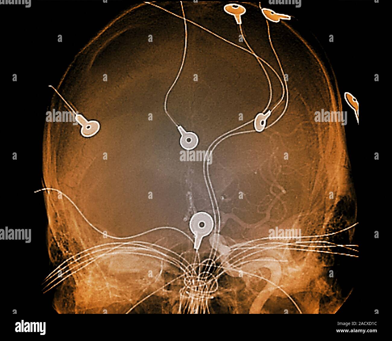 Farbige Angiogramm (Blutgefäß X-ray) eines epileptischen 40 year-old ...