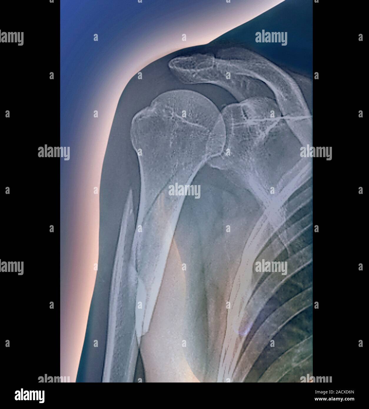 Arm gebrochen. Farbige X-ray von eine 27 Jahre alte Frau gebrochenen ...