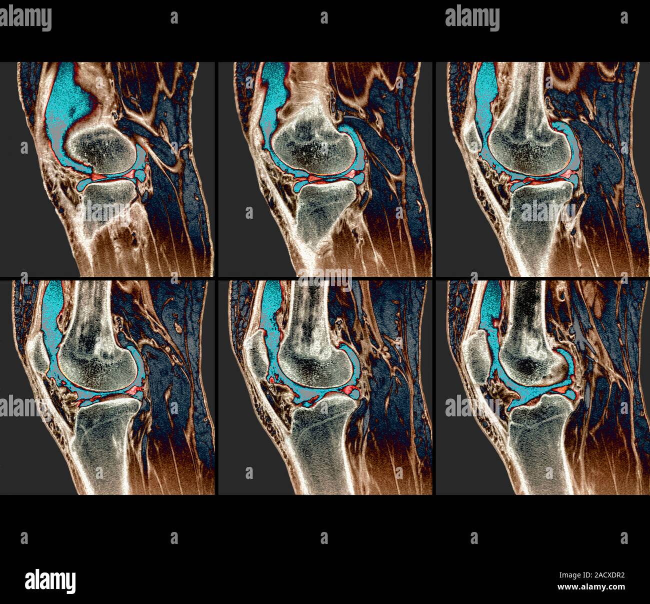 Knie-verstauchung. Farbige Magnetresonanztomographie (MRT) Scans der ...
