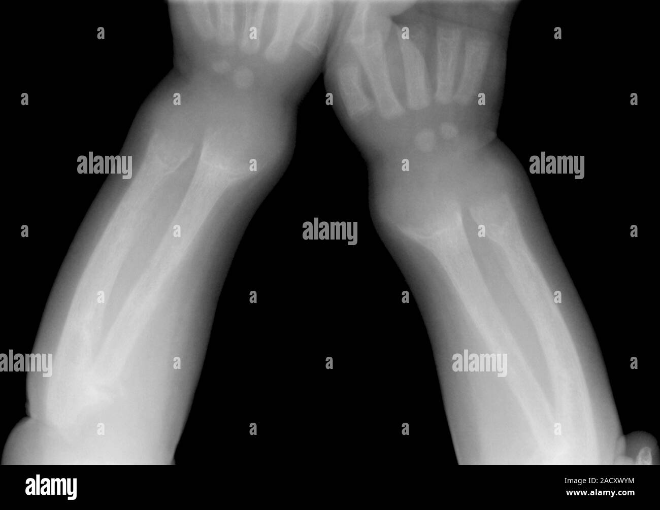 X-ray von der unteren Arme eines Kindes mit Rachitis und Osteomalazie ...