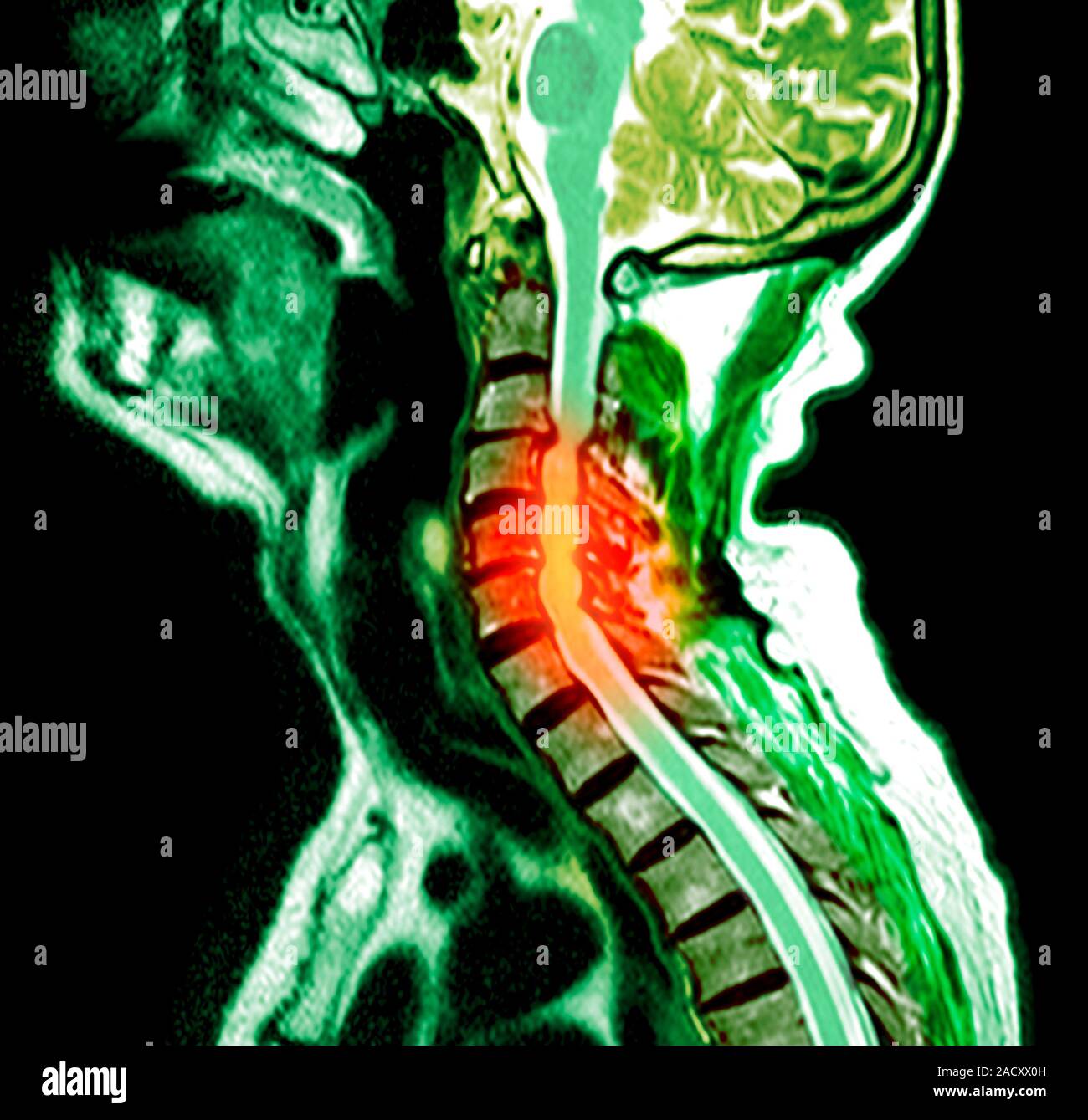 Farbige Magnetresonanztomographie Mrt Scan Der Zervikalen Wirbelsäule Nacken Eines Patienten