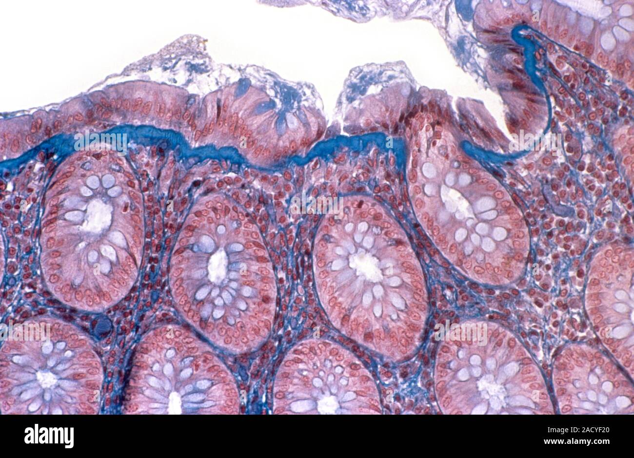 Kollagene Kolitis. Licht Aufnahme eines Abschnitts durch einen ...