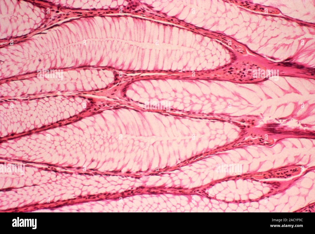 Darm polyp. Licht Aufnahme eines Abschnitts durch ein polyp im Colon ...