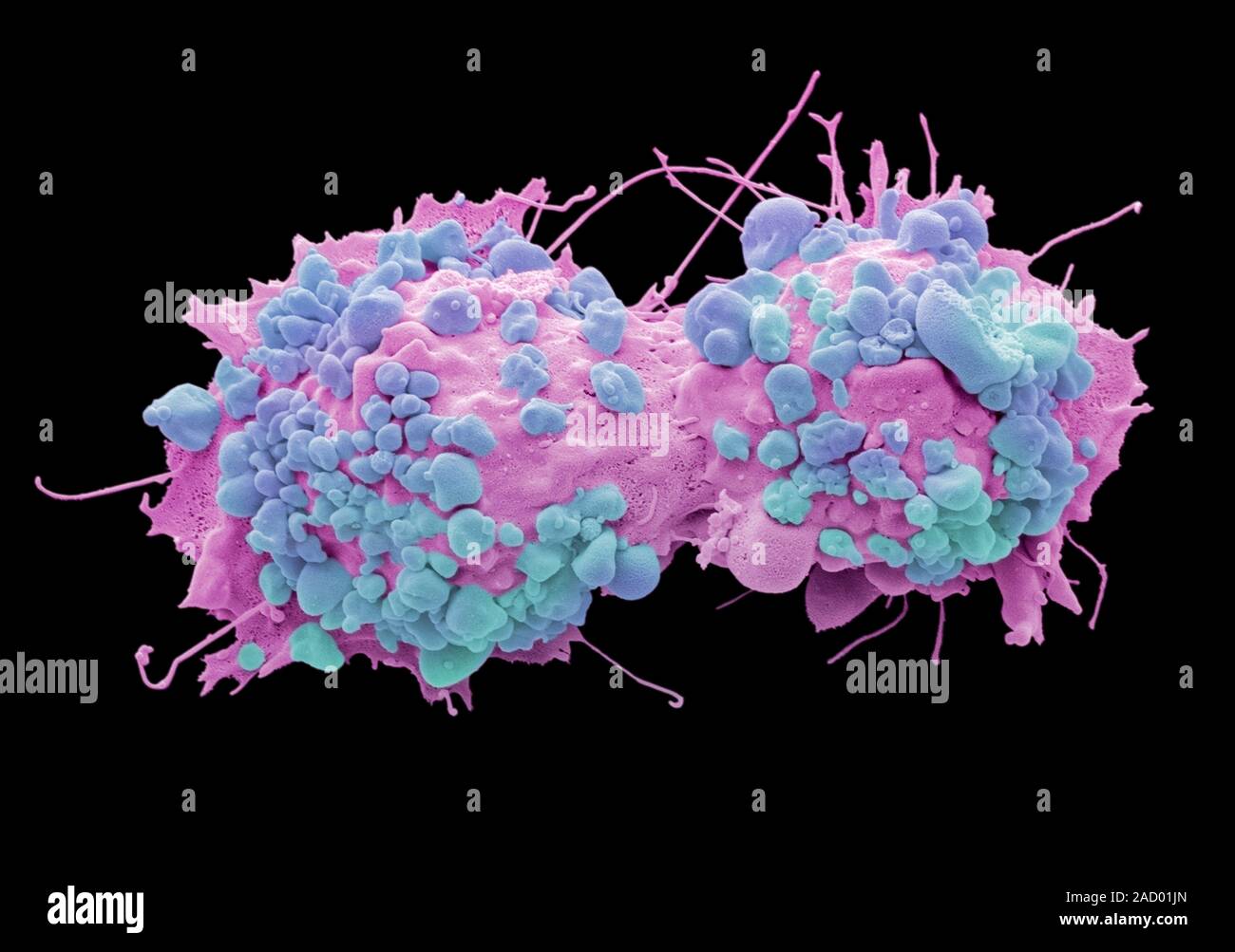 Ovarian Krebs Zellen. Farbige Scanning Electron Micrograph (SEM) der ...