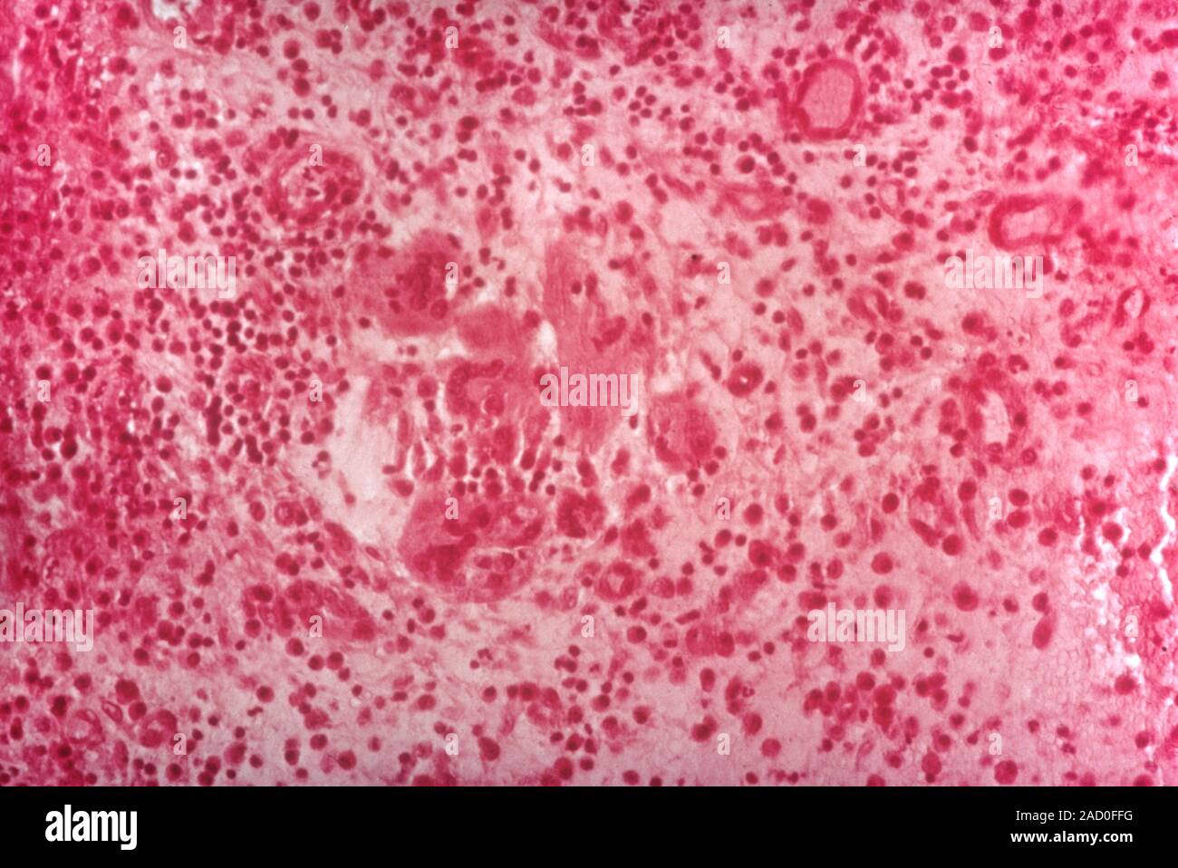 Granulom. Licht Aufnahme eines Abschnitts durch ein granulom. Granulome ...