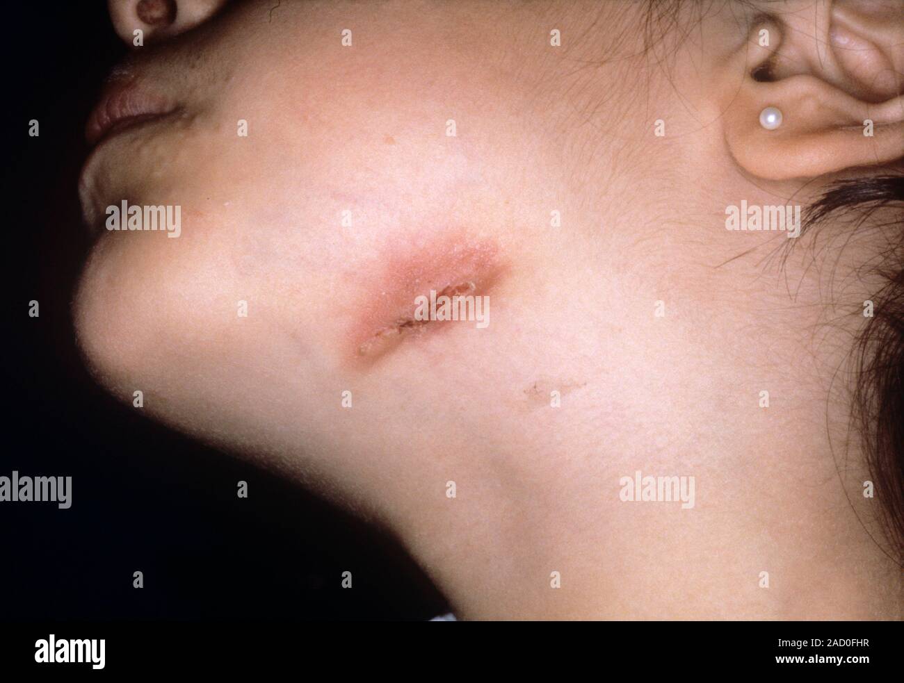 Speicheldrüsen Infektion. Wunde im Gesicht eines Patienten mit ...