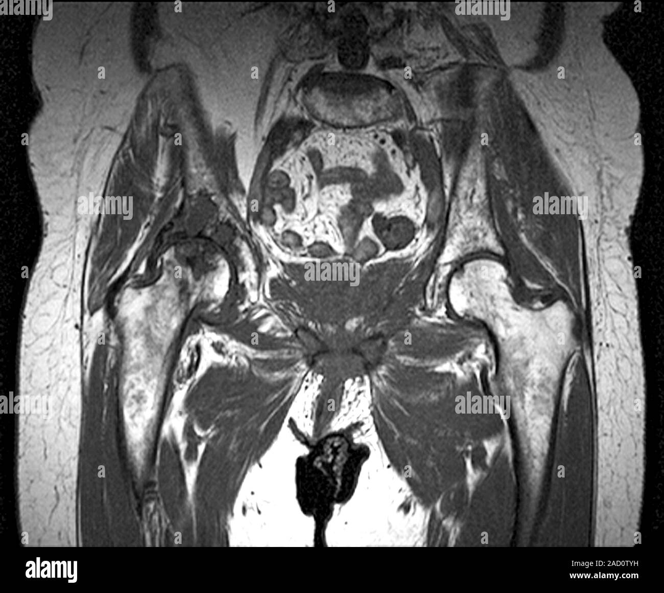 Osteonekrose des Beckens. Die Magnetresonanztomographie (MRT) Scan ...