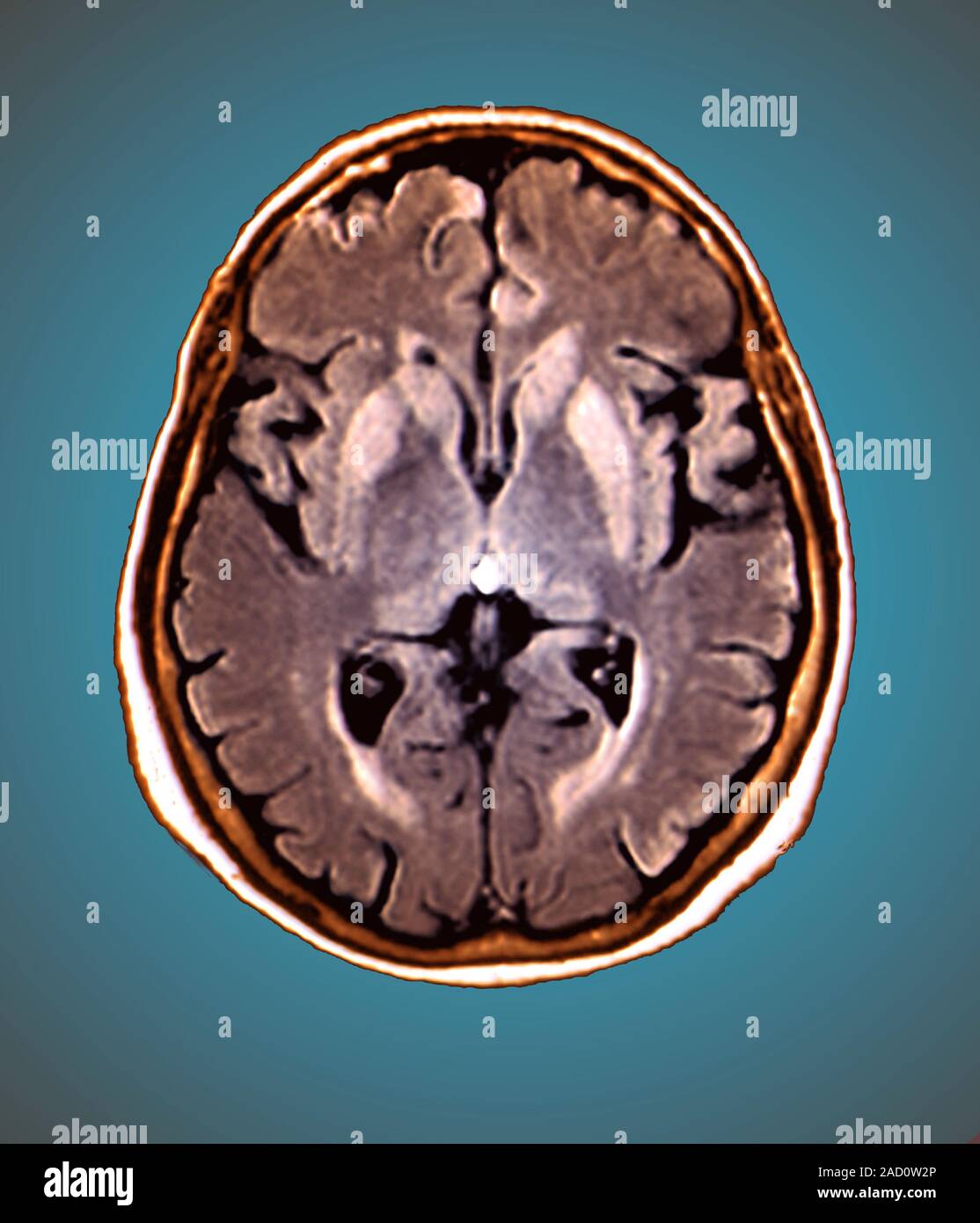 Gehirn in der Creutzfeldt-Jakob-Krankheit. FLAIR ...