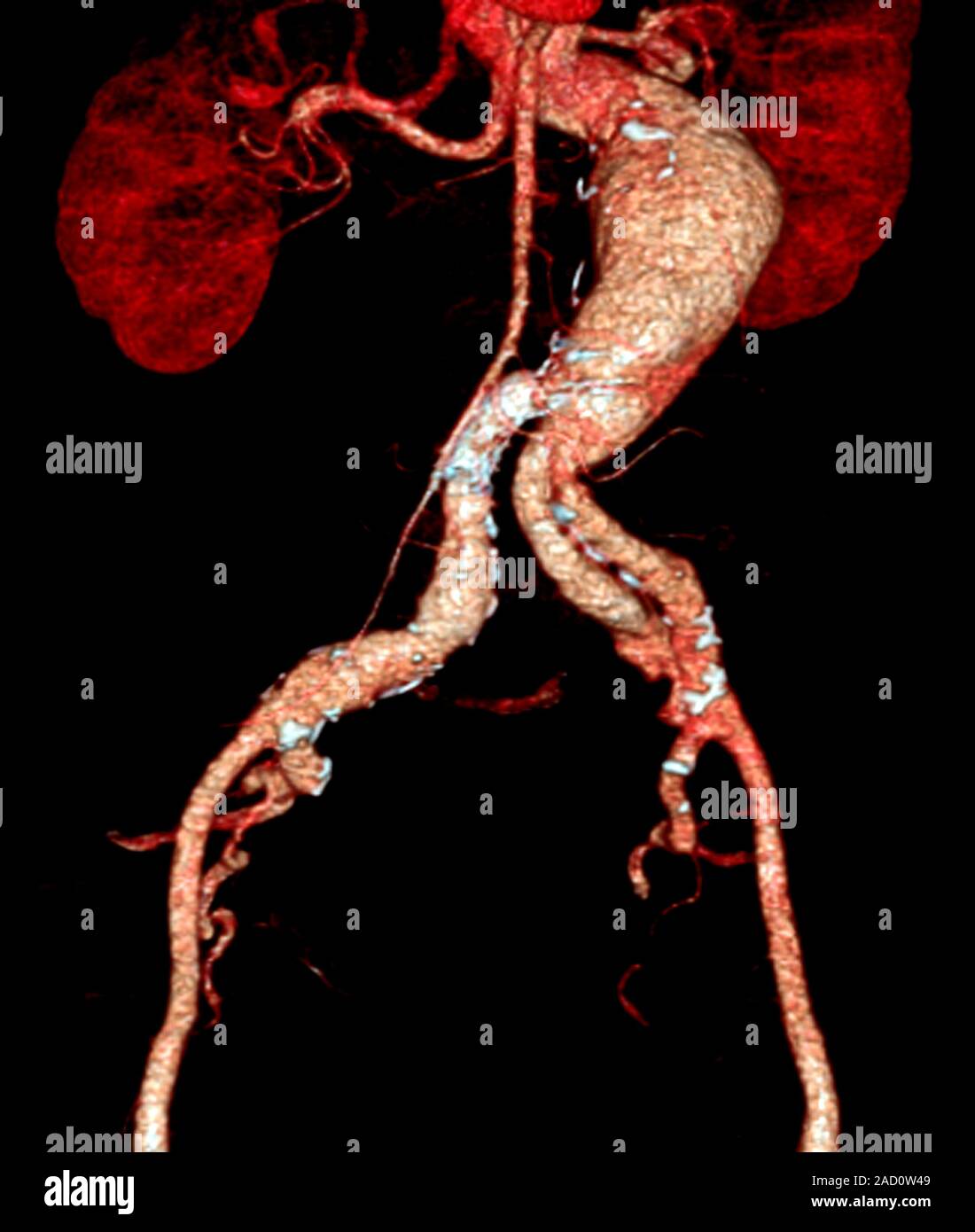Arterielle Aneurysmen in Marfan Syndrom. 3D-Computertomographie (CT ...