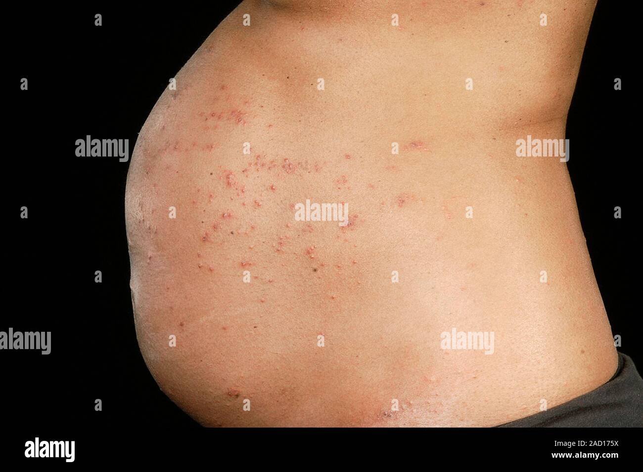 Polymorphic Eruption der Schwangerschaft. Bauch einer schwangeren Frau ...