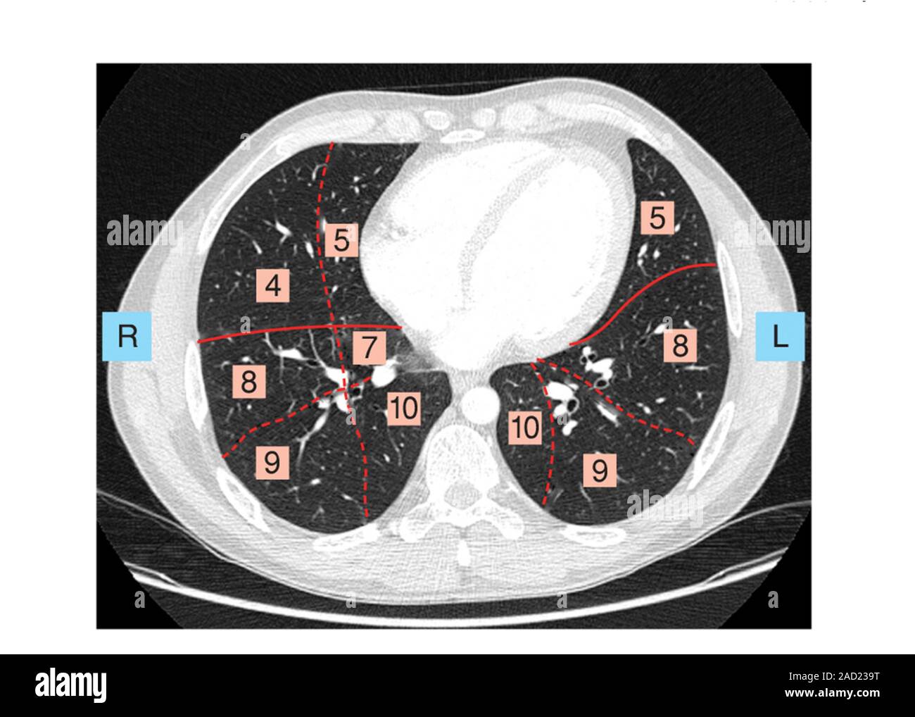 Darstellung der Lunge, Lungen Segmentierung im Thorax CT. Dieses Bild ...