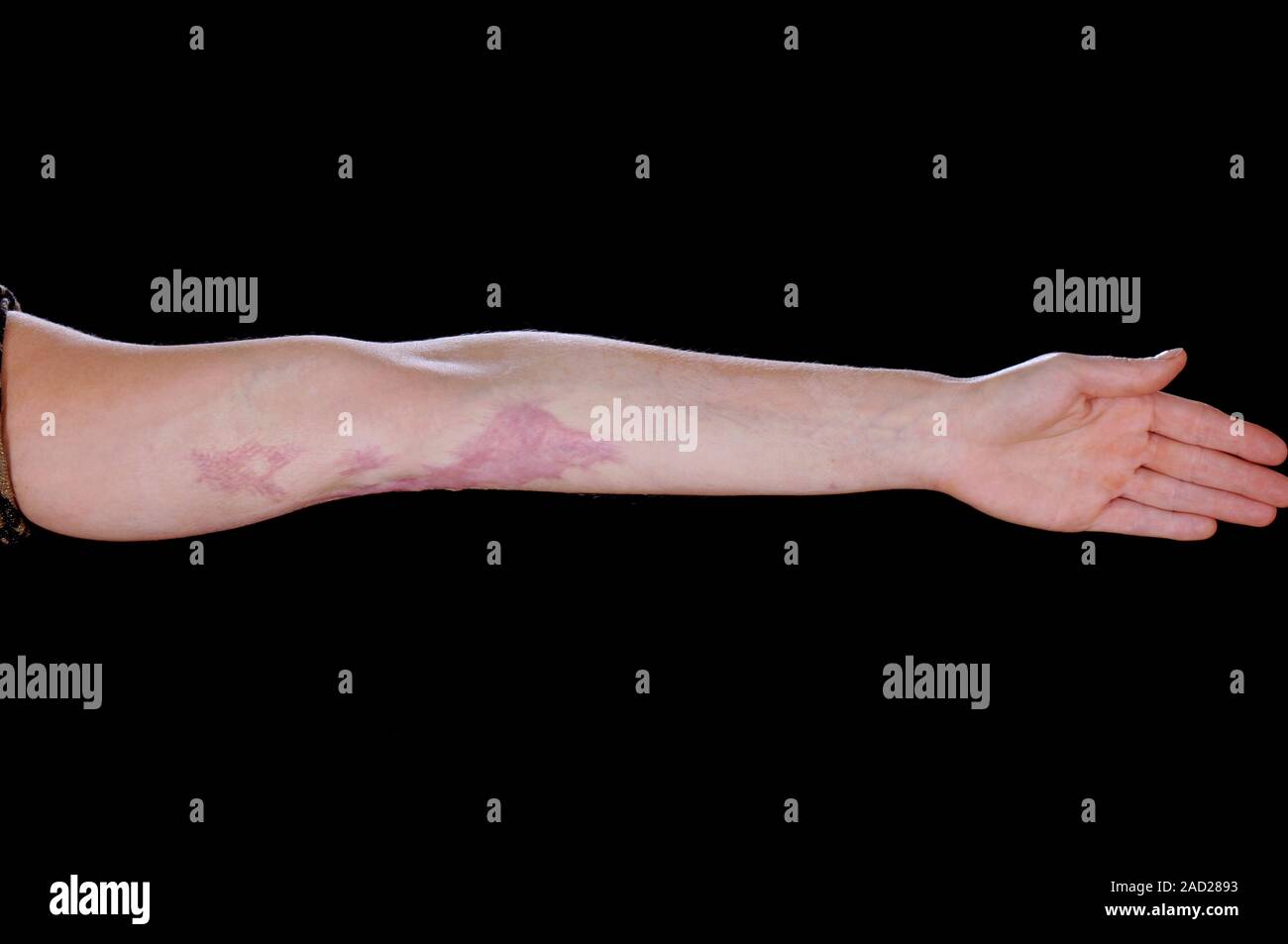 Verbrennungen Narbe. Schrammen von Verbrennungen Verletzungen am Arm ...