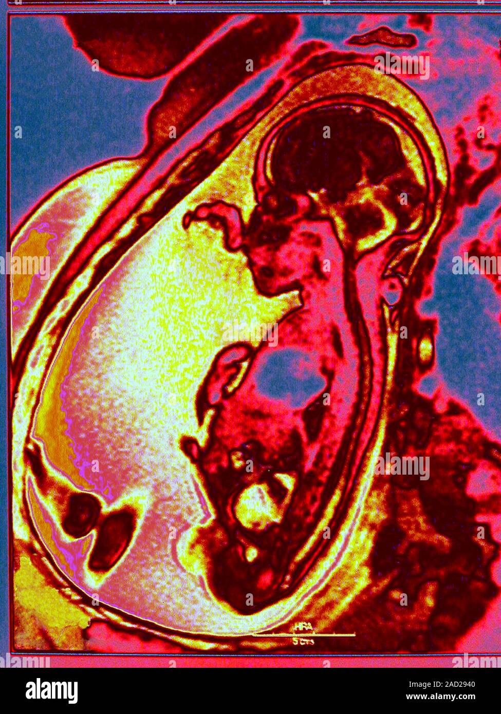 Fetus in der Gebärmutter. Die Magnetresonanztomographie (MRT) Scan ...