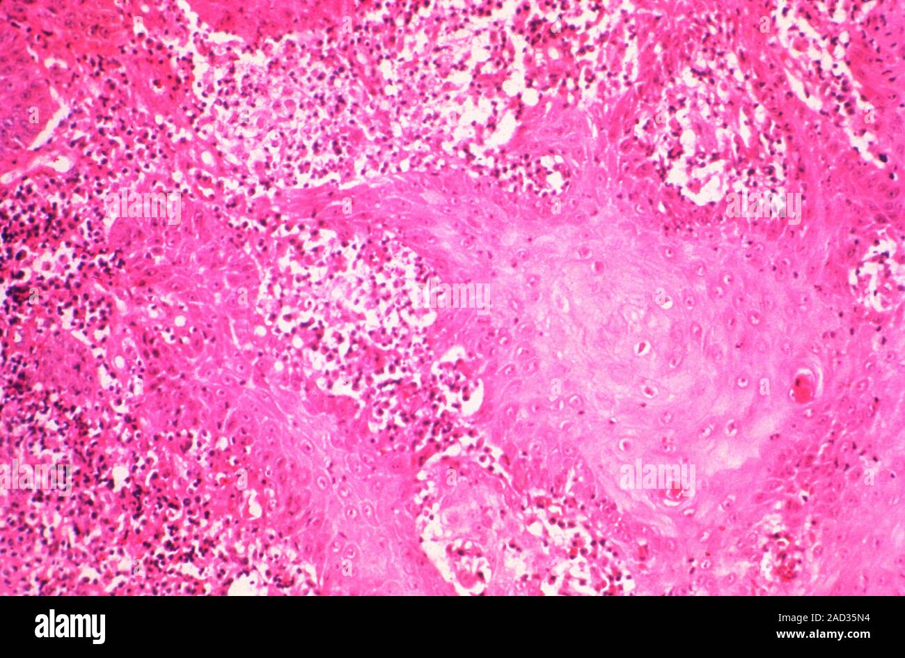 Granuloma inguinale. Licht Aufnahme eines Abschnitts durch Gewebe einer ...