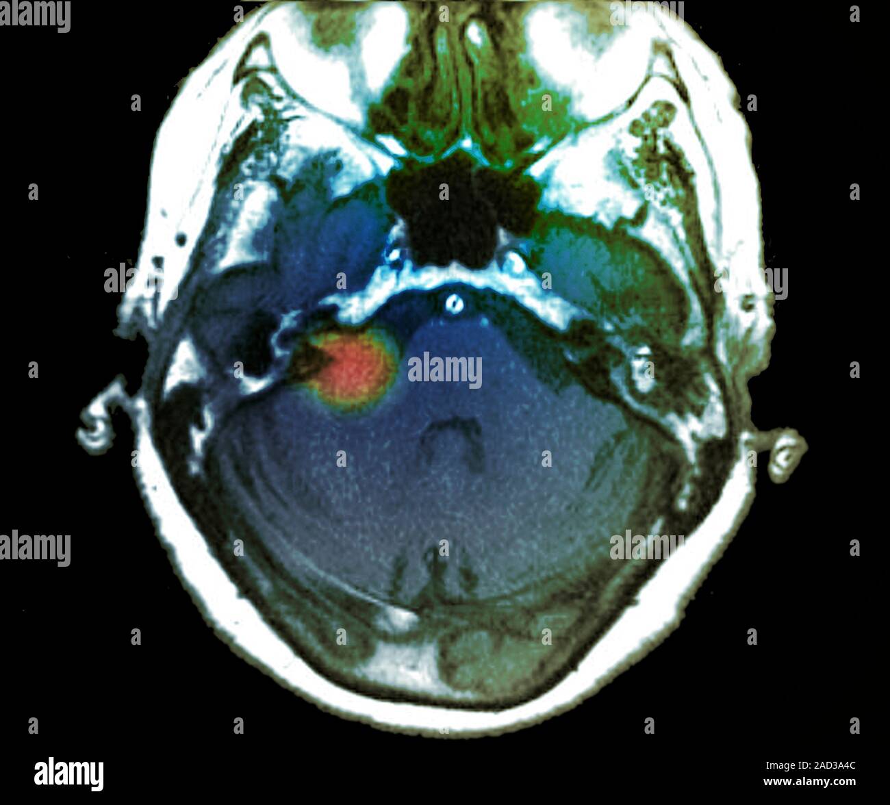 Hirntumor. Farbige Magnetresonanztomographie (MRT) Scan eines axialen ...