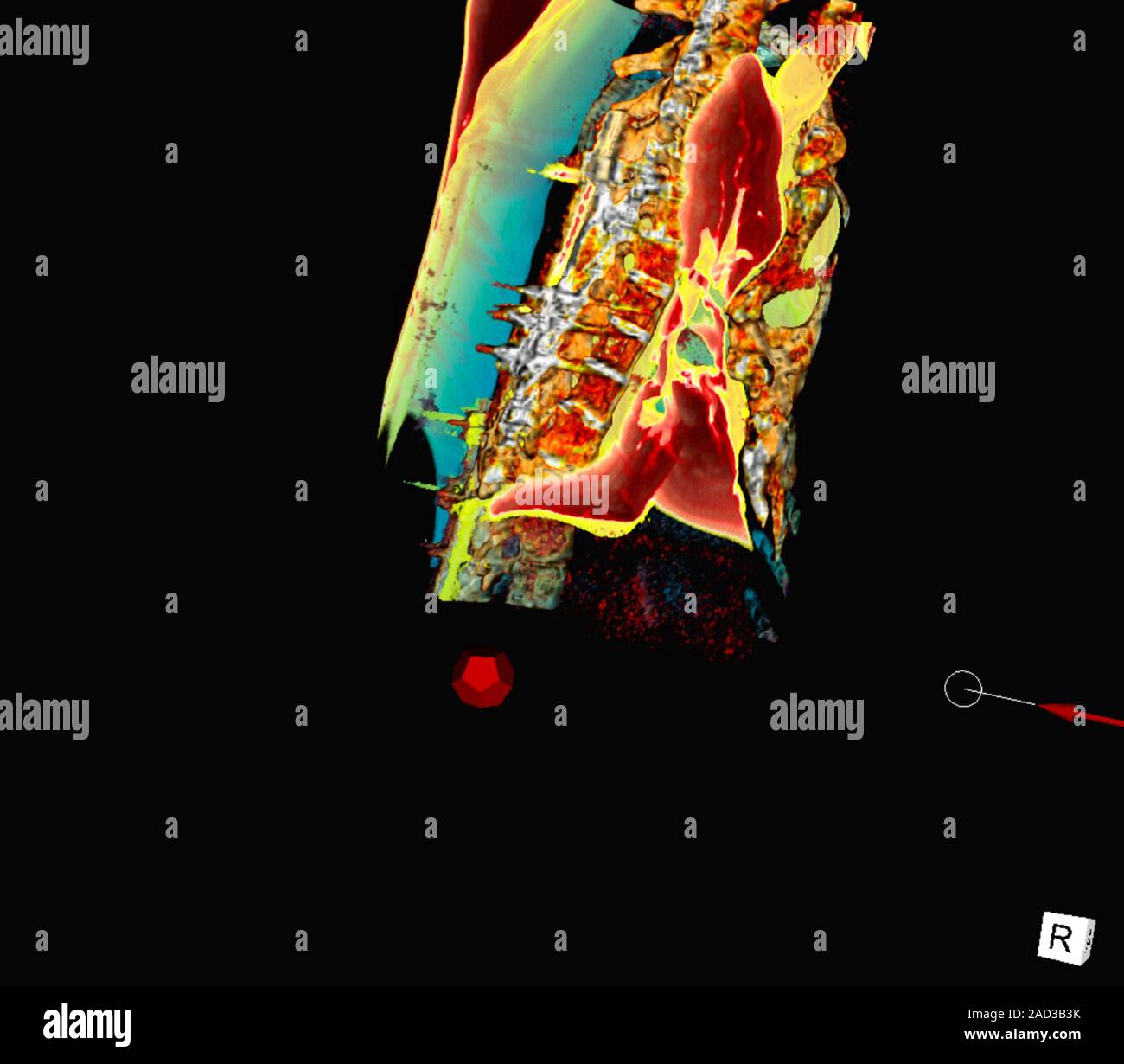 Versunkene Brust (pectus excavatum). 3D-Computertomographie (CT) von ...